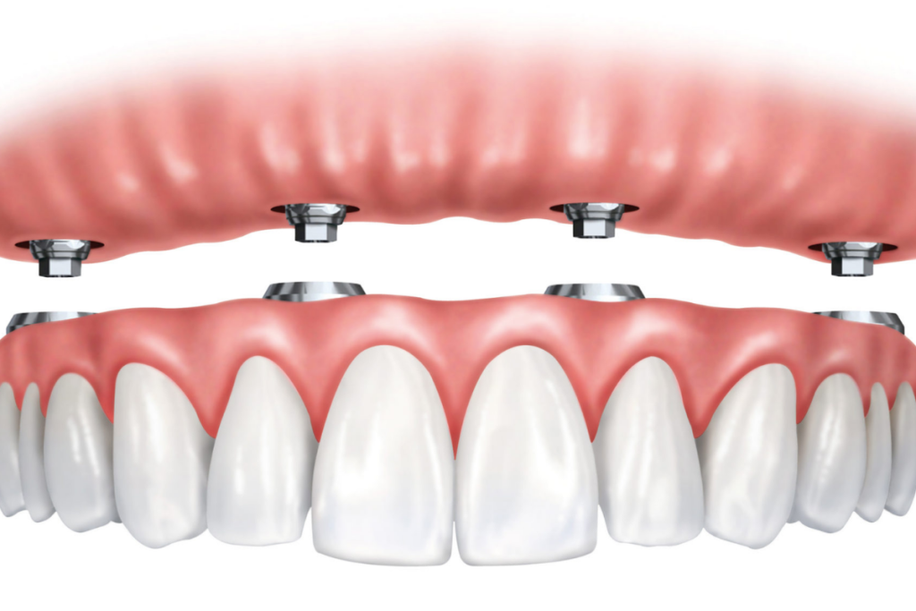 What Are Implant-Supported Dentures - Ashburton Dental Centre Gosnells